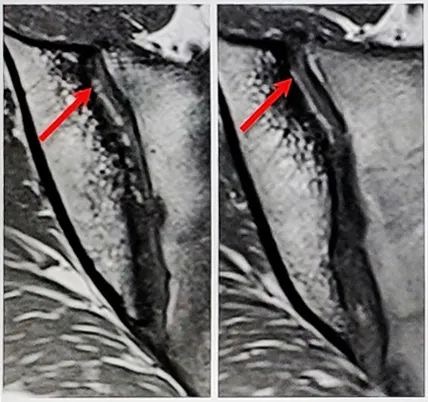 EULAR 2023 前沿资讯丨axSpA领域重磅研究引领诊疗新方向 - 医疗保健专业人士的治疗资源|Wiley Knowledge Hub